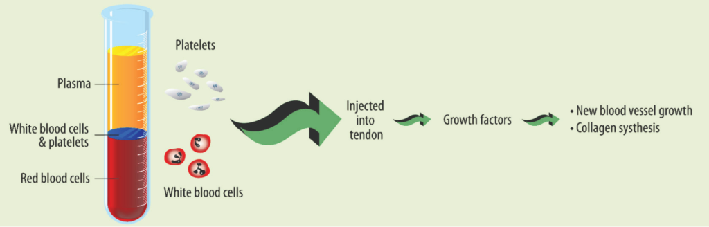 PATIENT LEAFLET FOR HAVING PRP INJECTION – The MSK & Pain Clinic